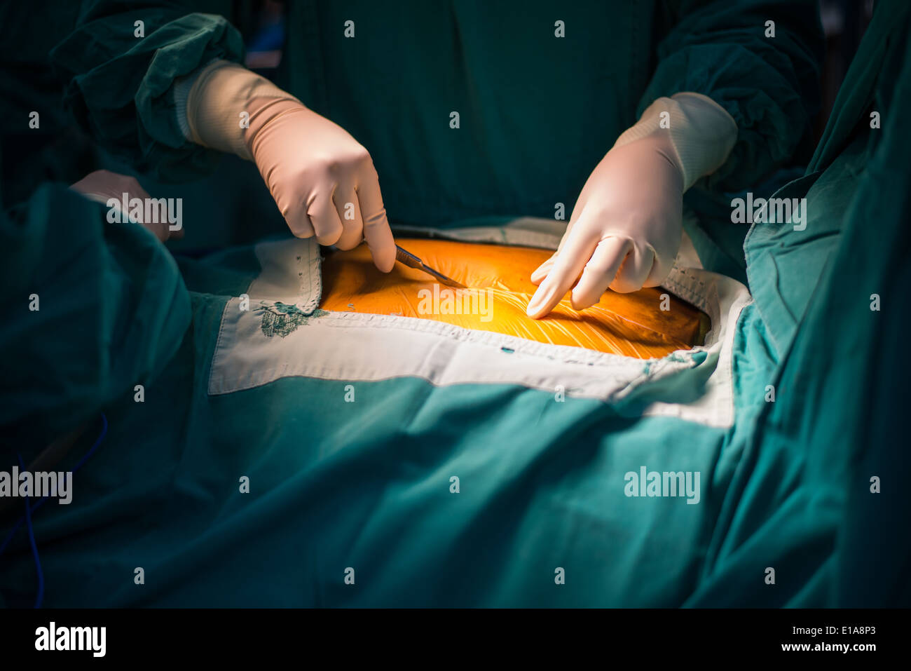 median sternotomy incision Stock Photo - Alamy