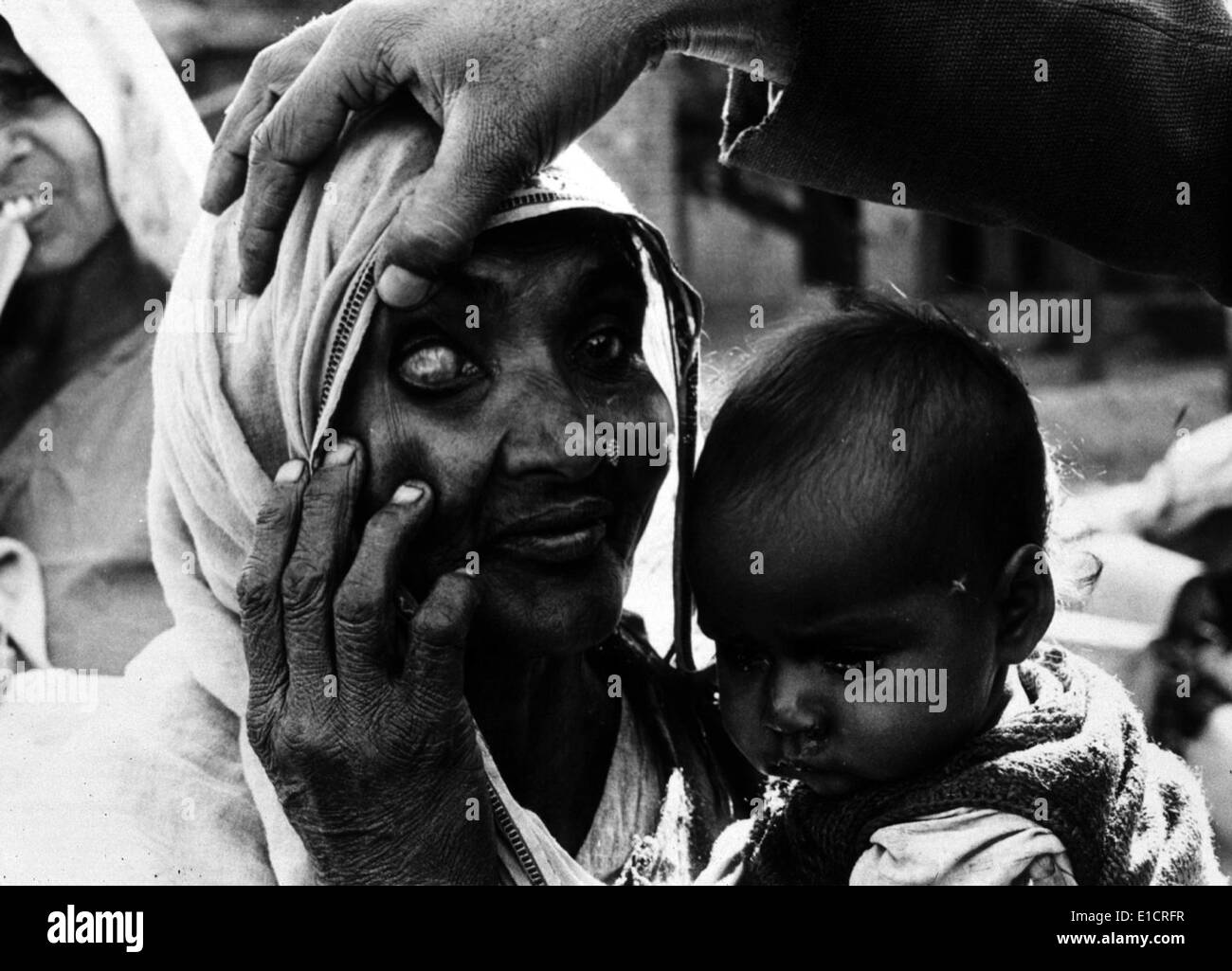 Trachoma hi-res stock photography and images - Alamy