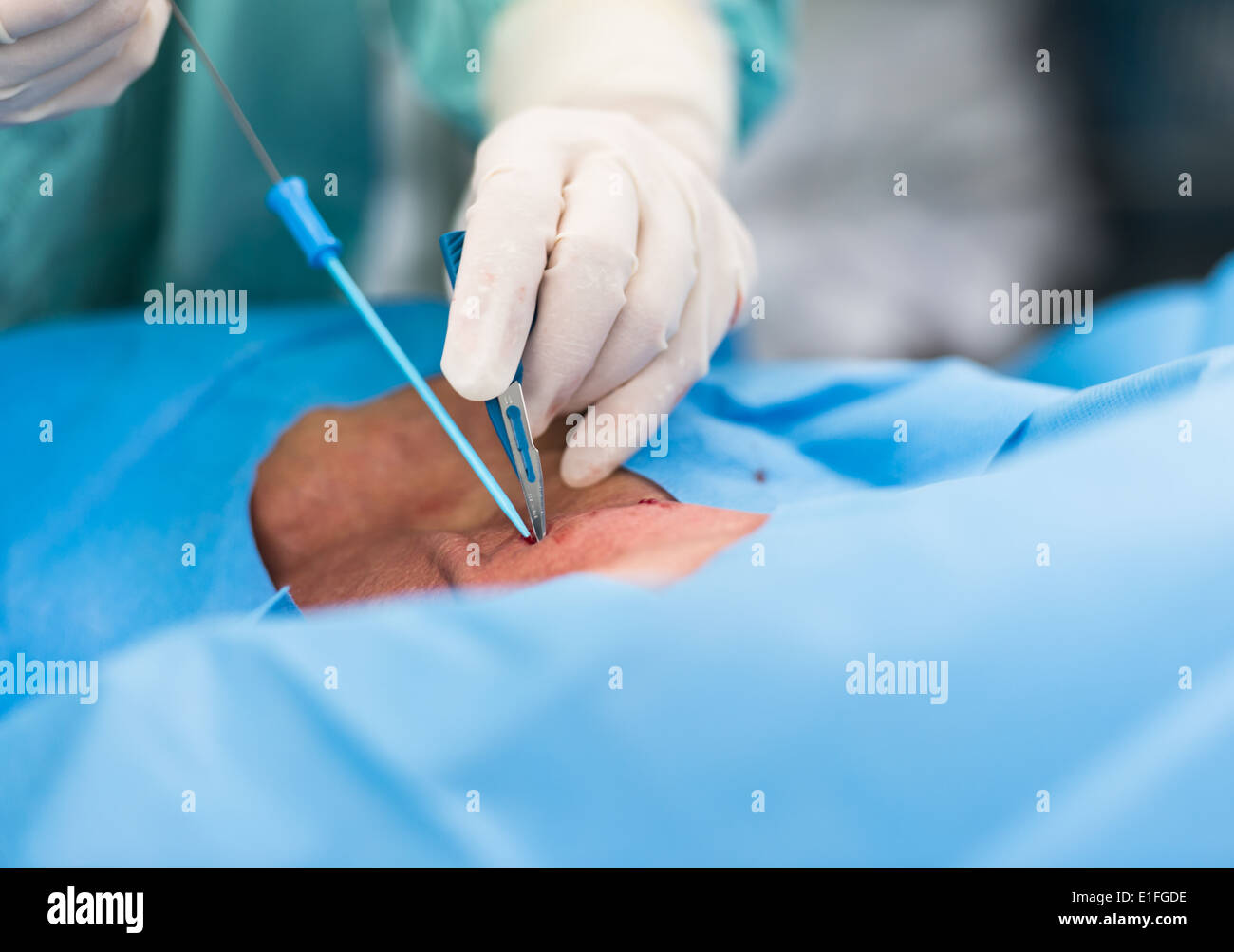central venous pressure Stock Photo - Alamy