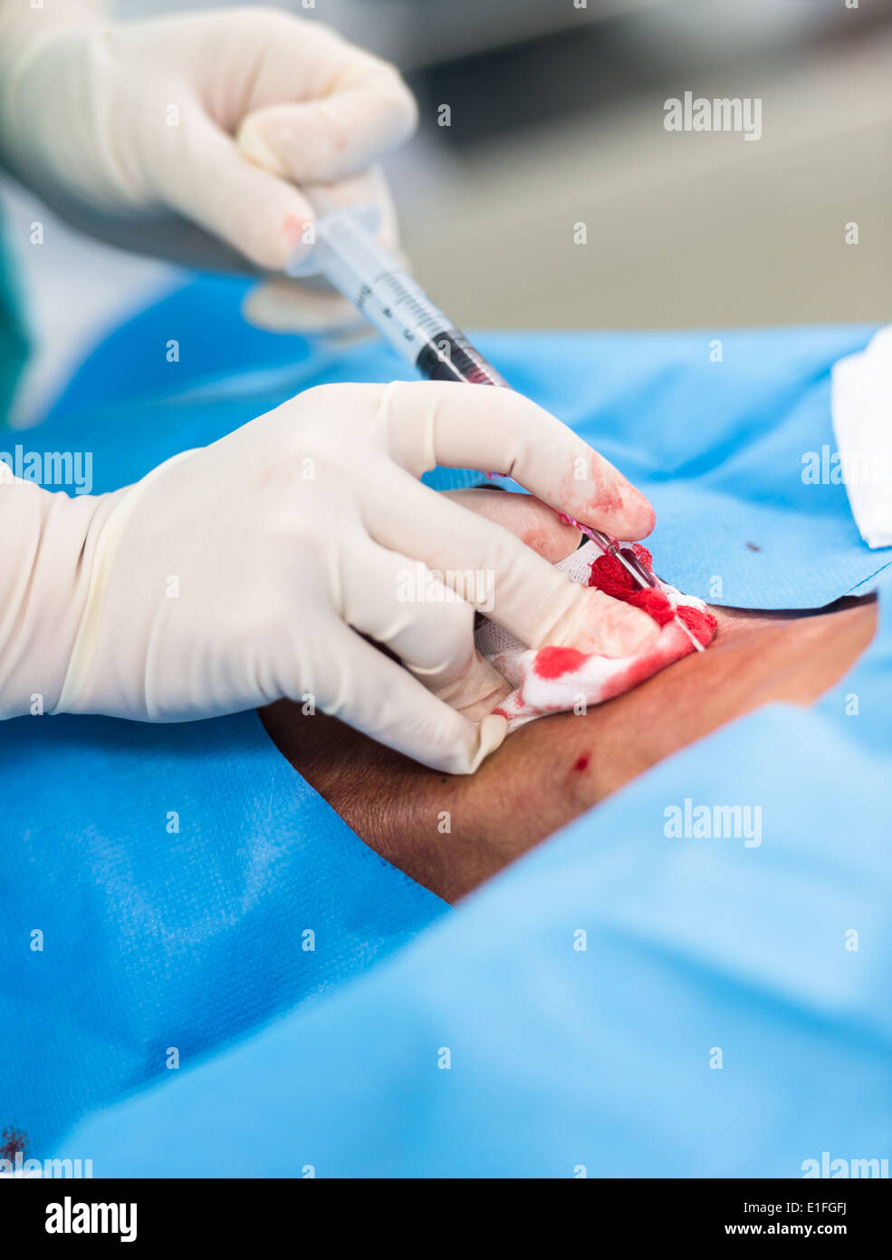 Central venous pressure hi-res stock photography and images - Alamy