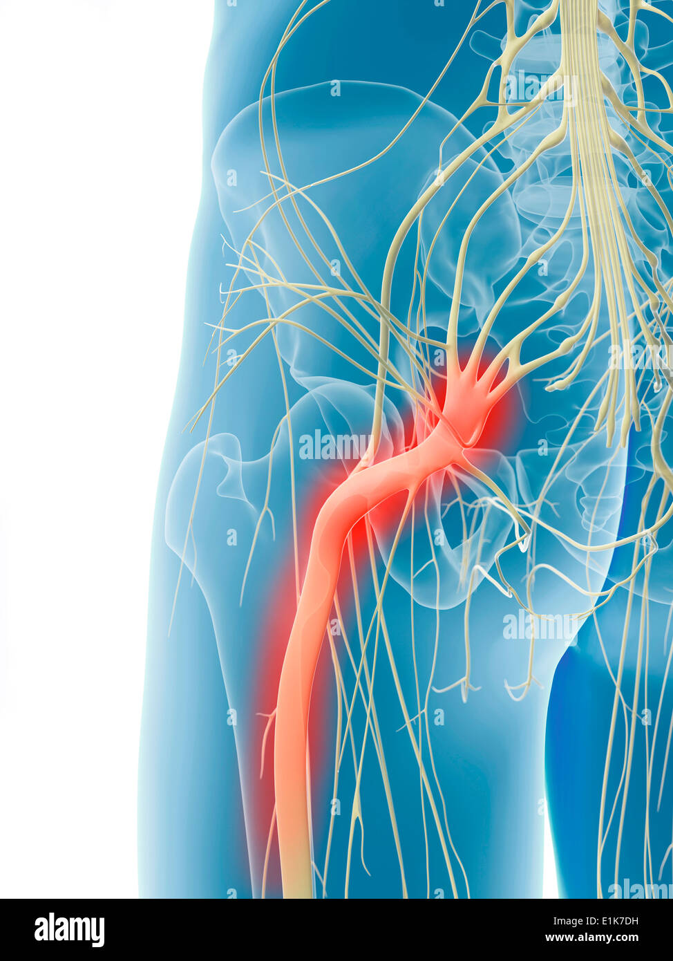 Inflamed sciatic nerve computer artwork Stock Photo - Alamy