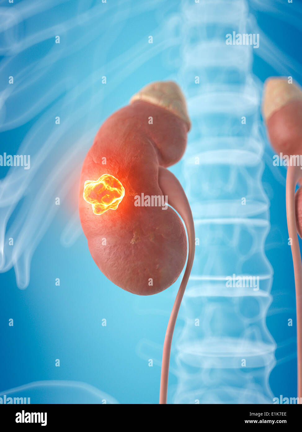 Human kidney showing cancerous tumor computer artwork Stock Photo - Alamy