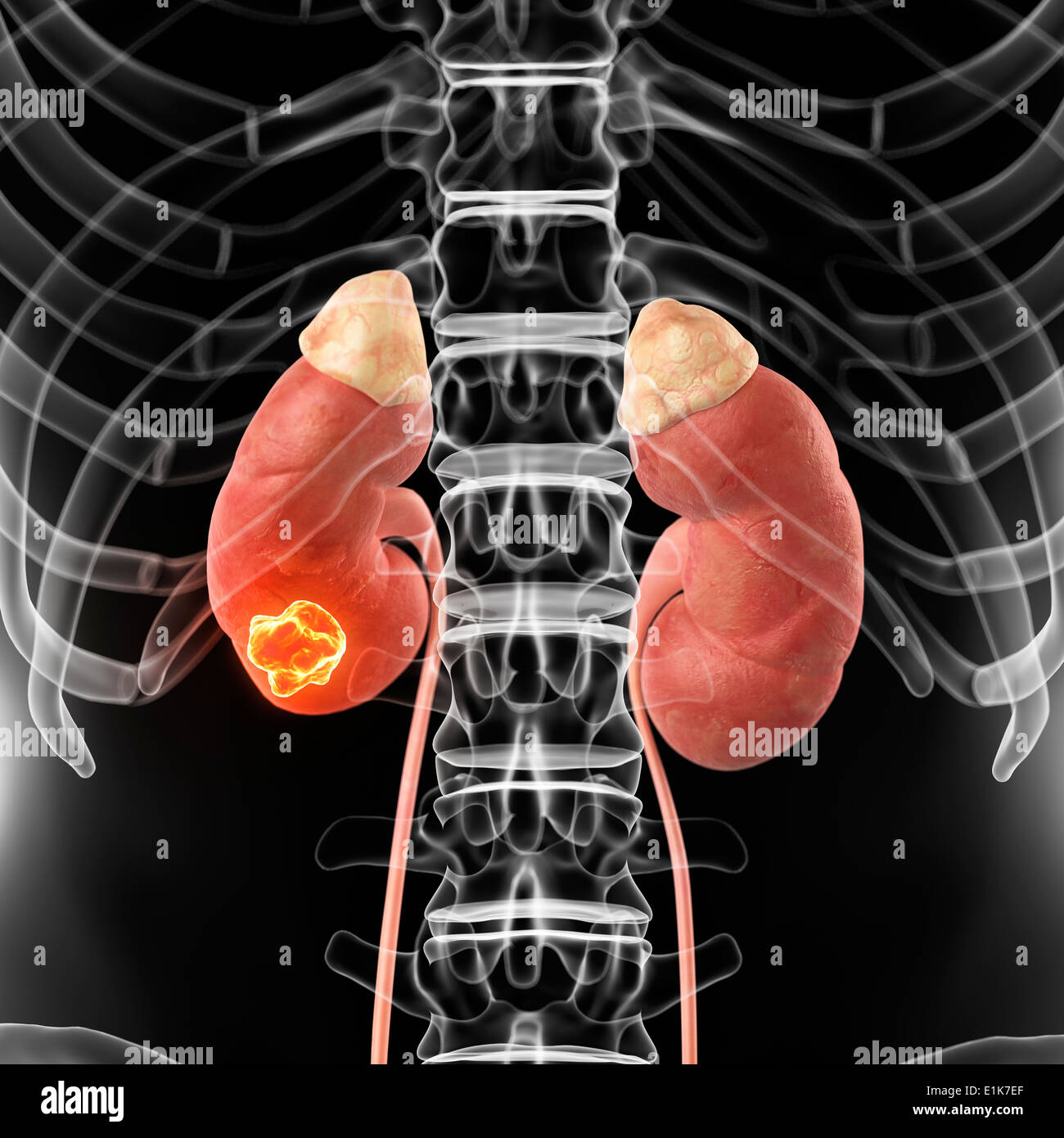 Kidney tumor hi-res stock photography and images - Alamy
