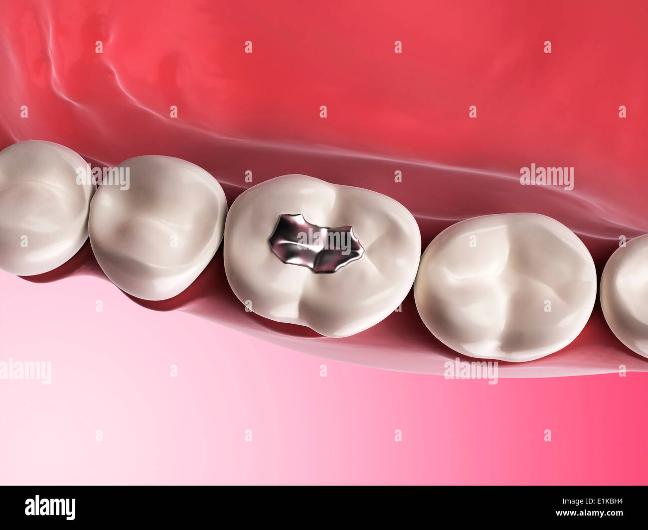 Human tooth with an amalgam filling computer artwork Stock Photo - Alamy
