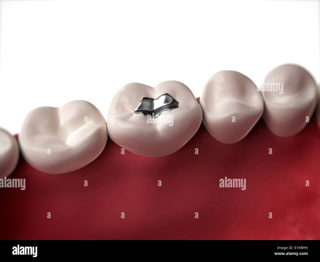 Human tooth with an amalgam filling computer artwork Stock Photo - Alamy