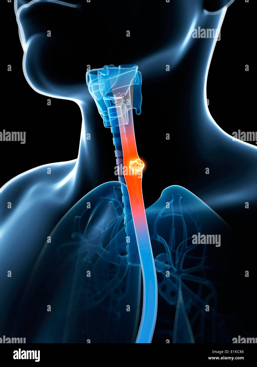 Human food pipe oesophagus tumour hi-res stock photography and images ...