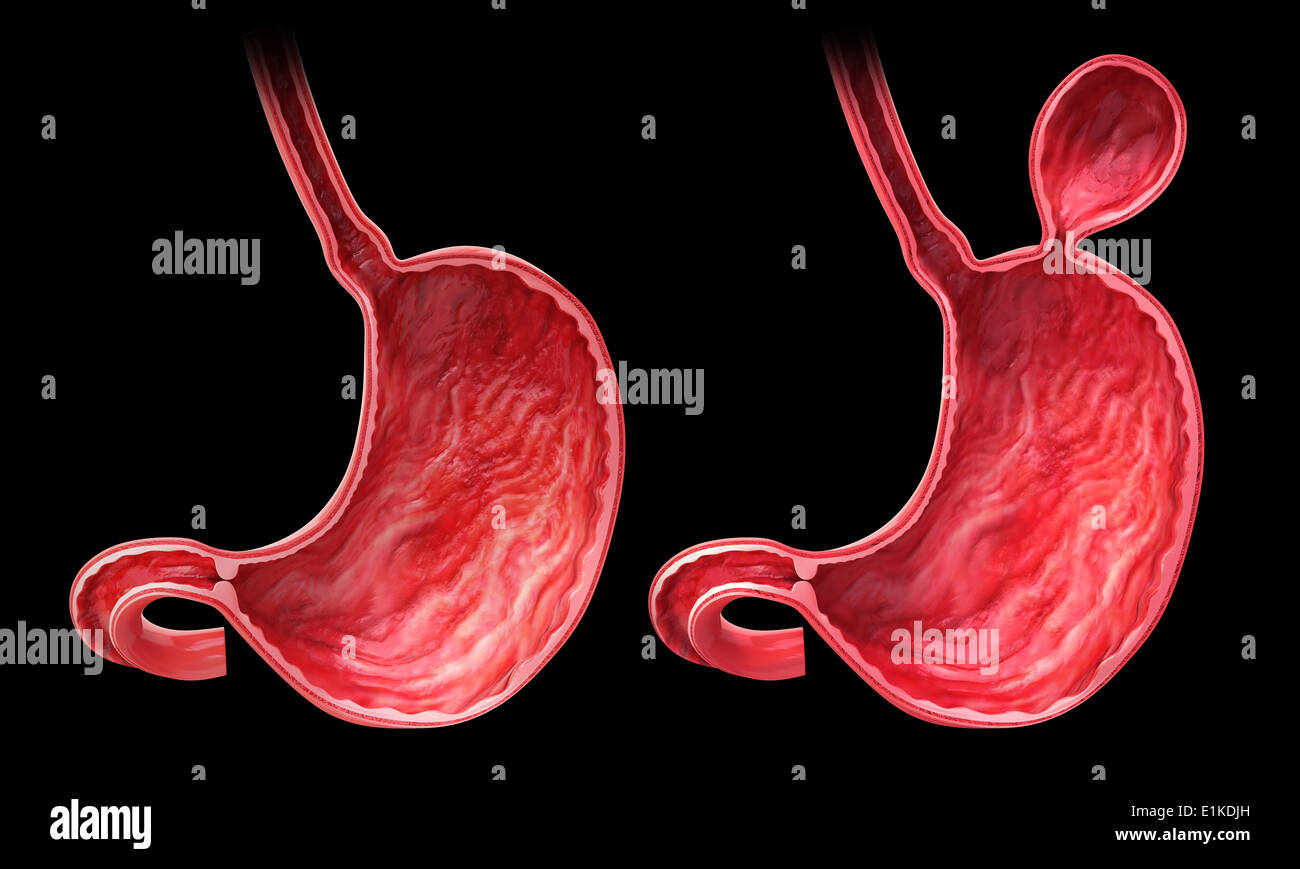 Hiatal hernia hi-res stock photography and images - Alamy