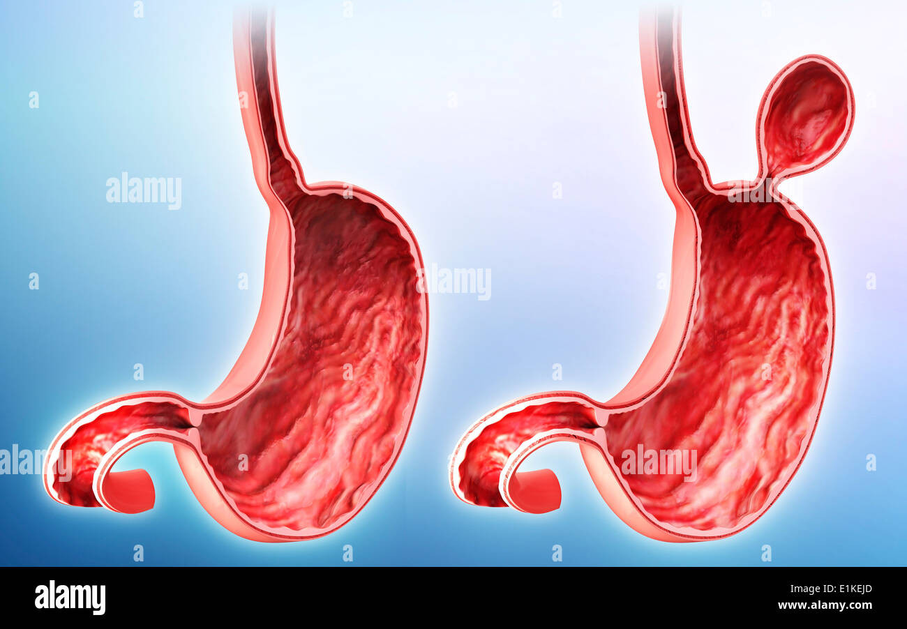 Human stomach with hernia cut-away computer artwork Stock Photo - Alamy