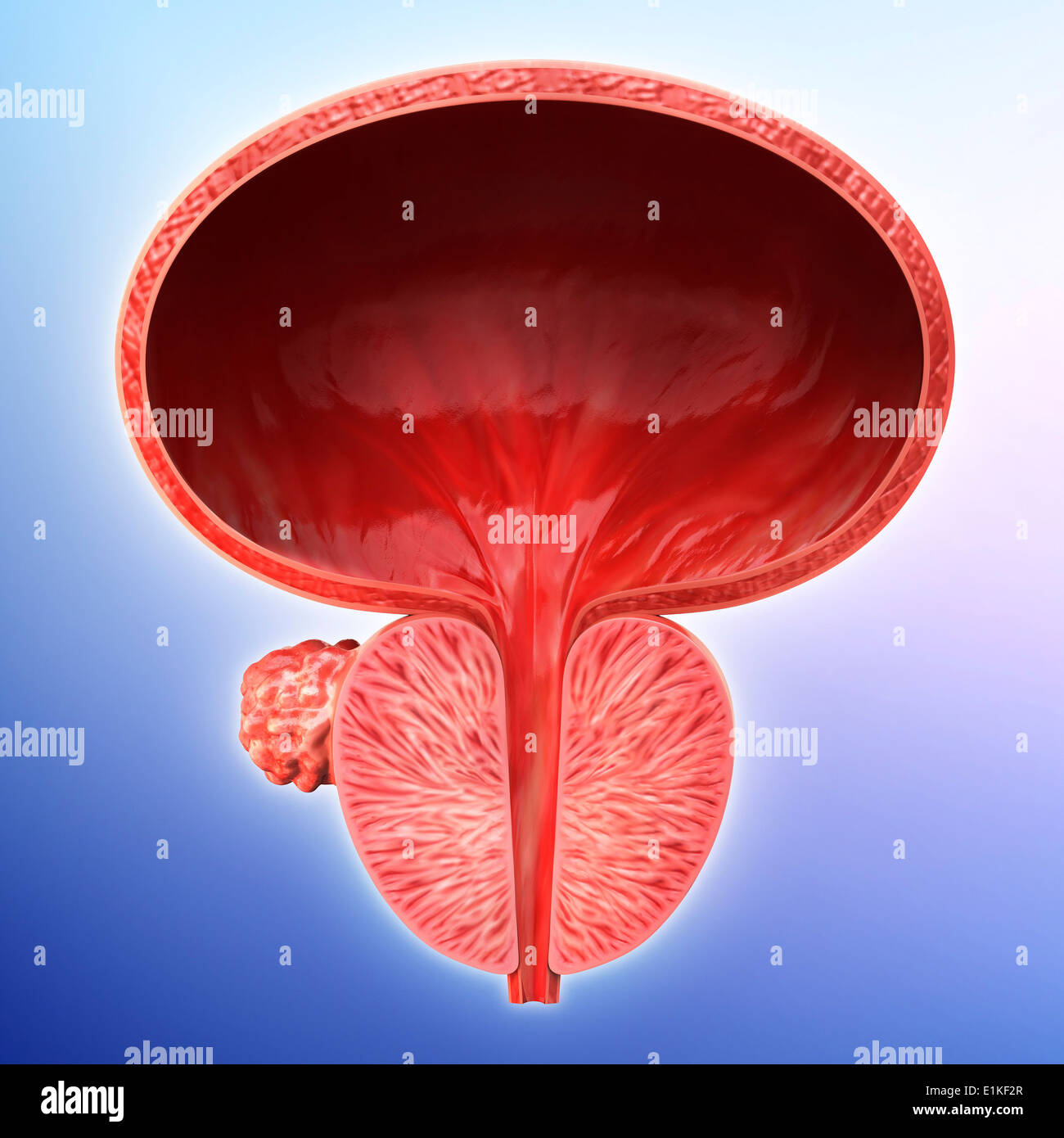 Human prostate gland tumour cut-away computer artwork Stock Photo - Alamy