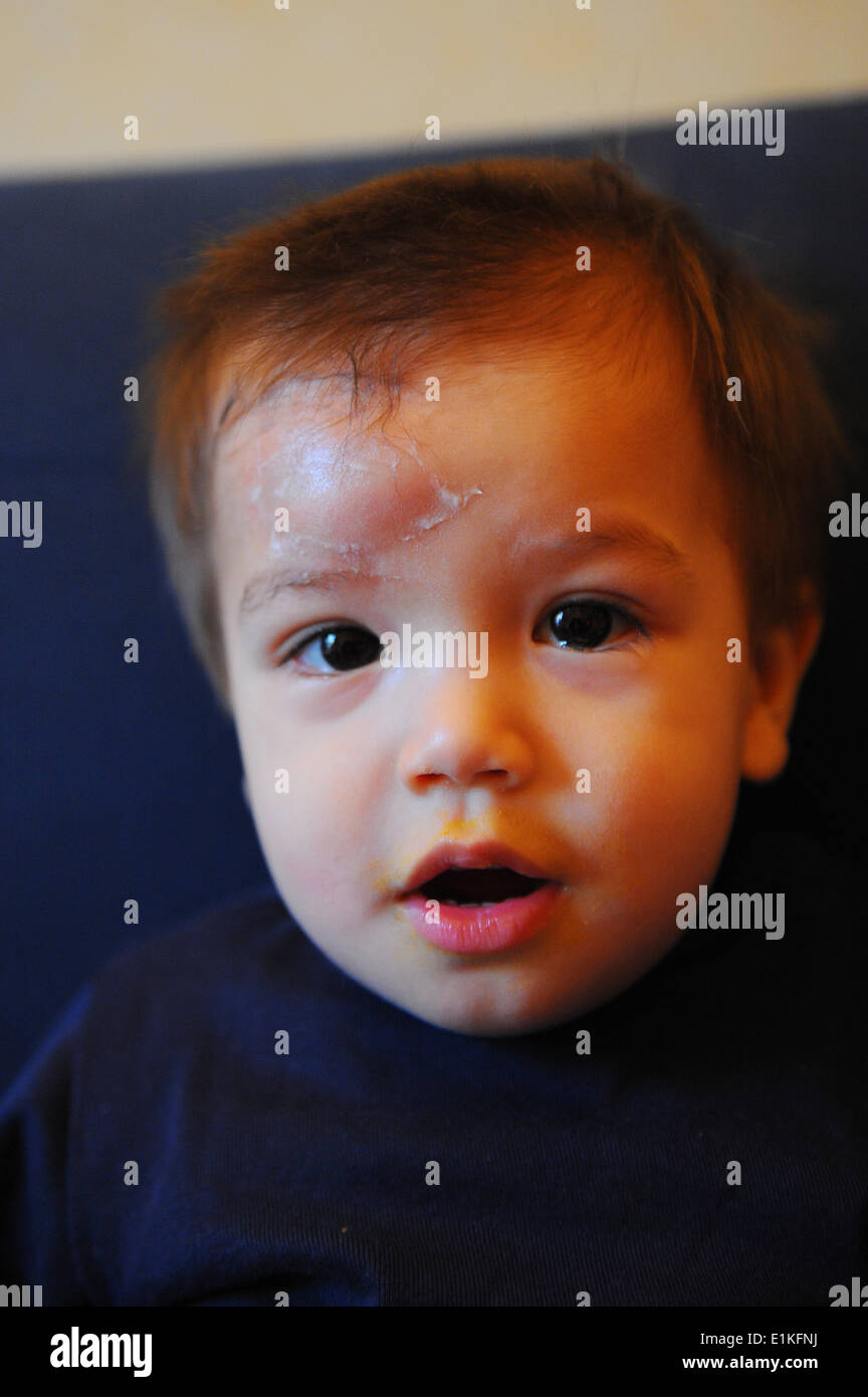 Child's bruised forehead Stock Photo - Alamy