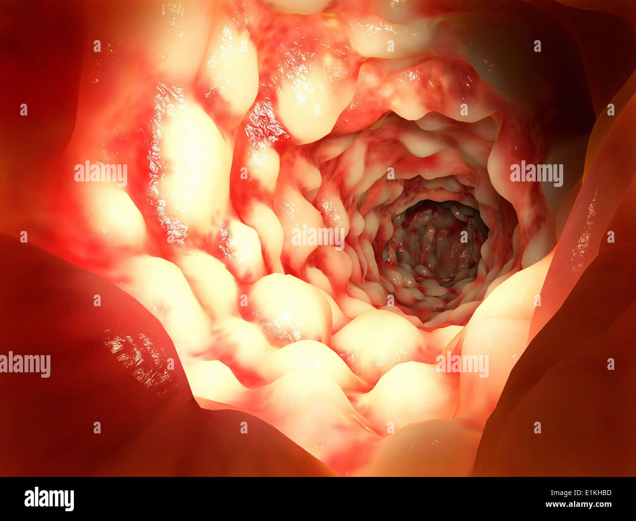 Artwork based on an endoscopic image of the intestine affected by crohn ...
