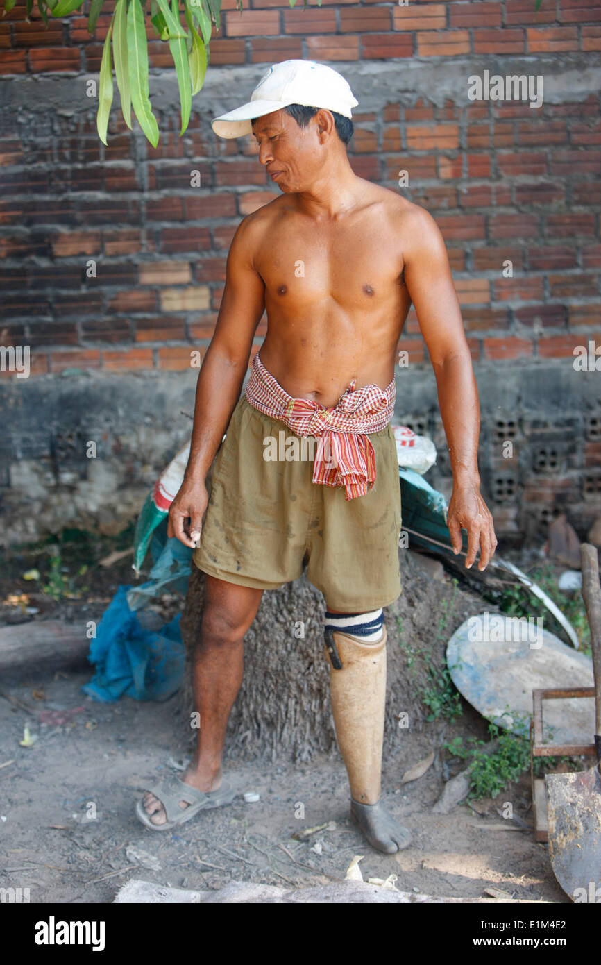 Landmine victim hi-res stock photography and images - Alamy