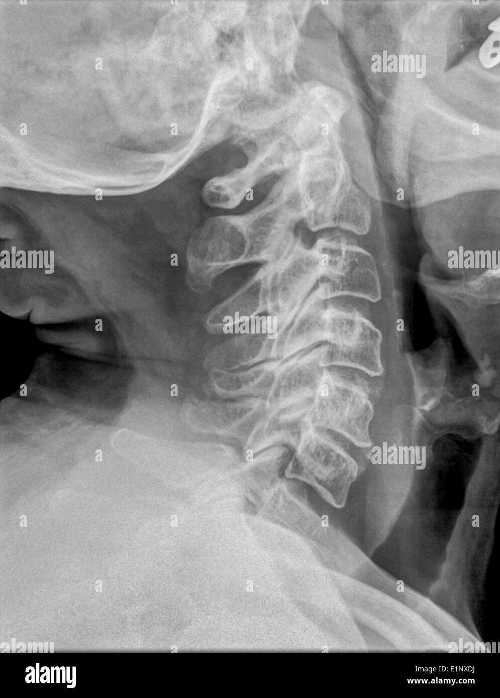 Normal Cervical spine x-ray of a 70 year old female patient side, view ...
