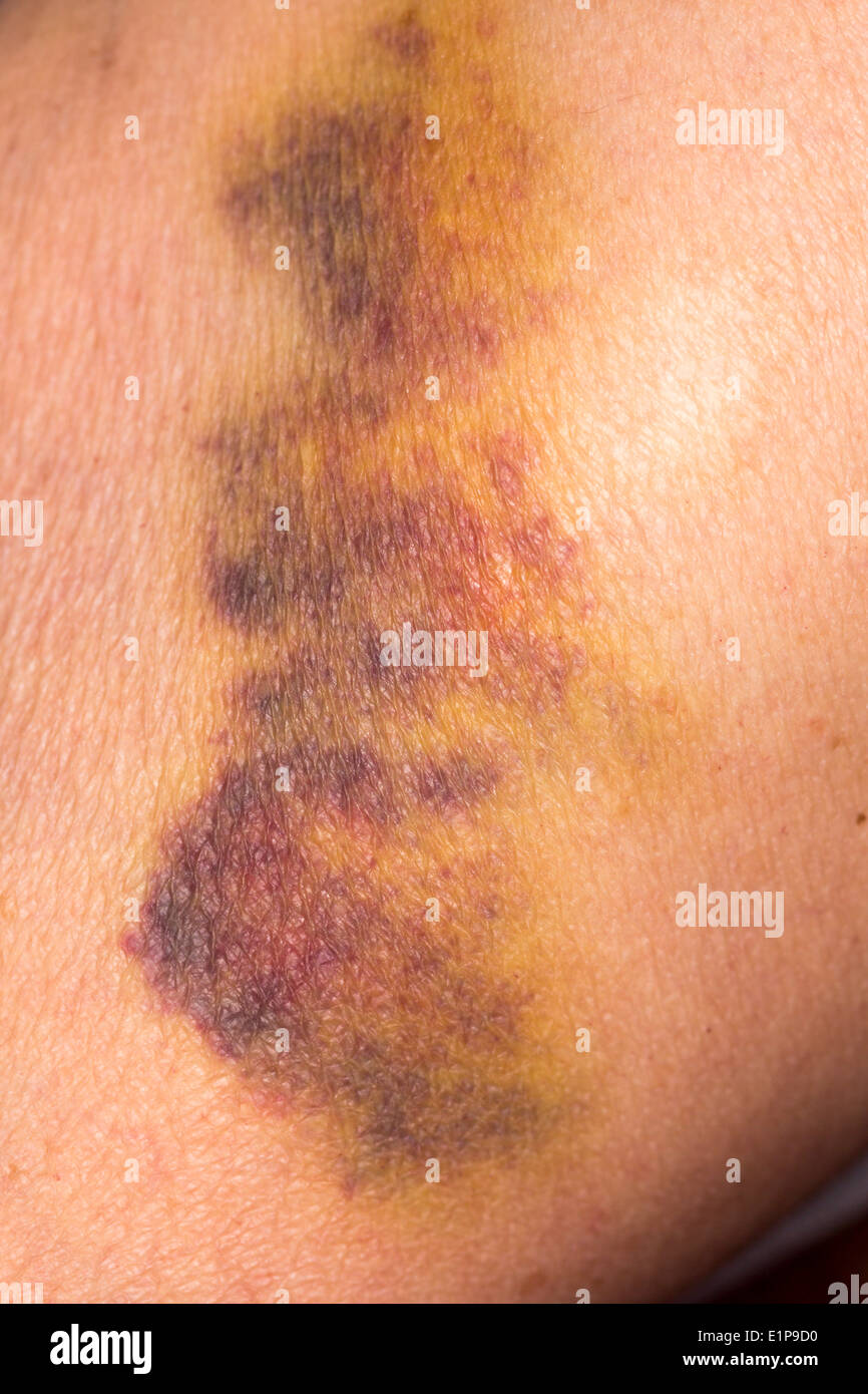 Handprint Bruise On Arm