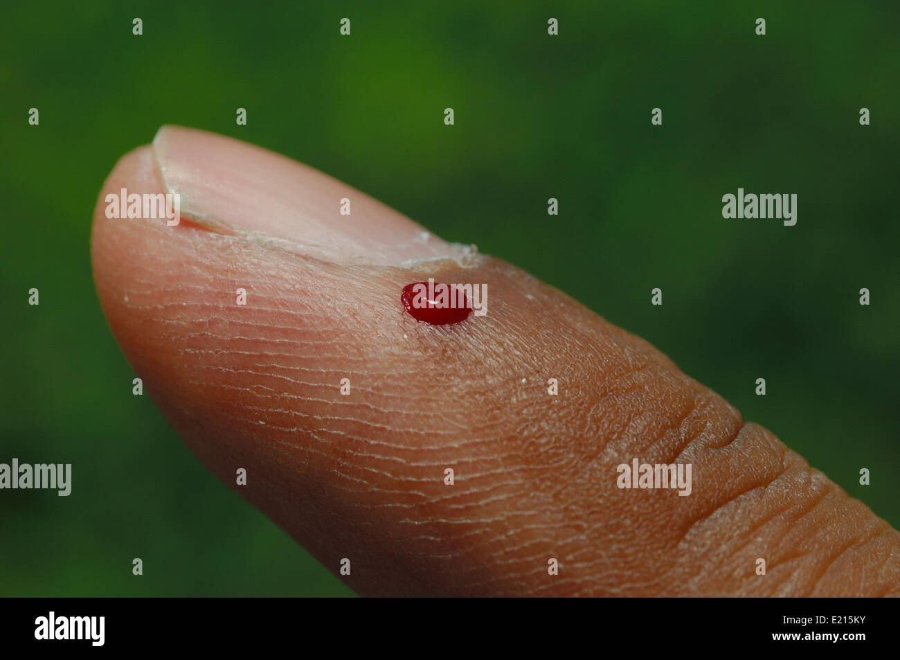 Blood Blister On Finger Nail Cuticle