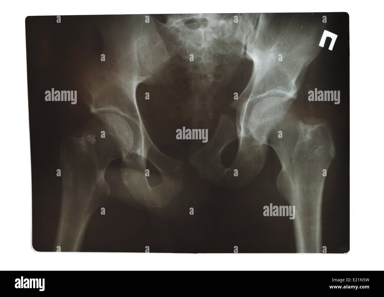 X ray femur Cut Out Stock Images & Pictures - Alamy