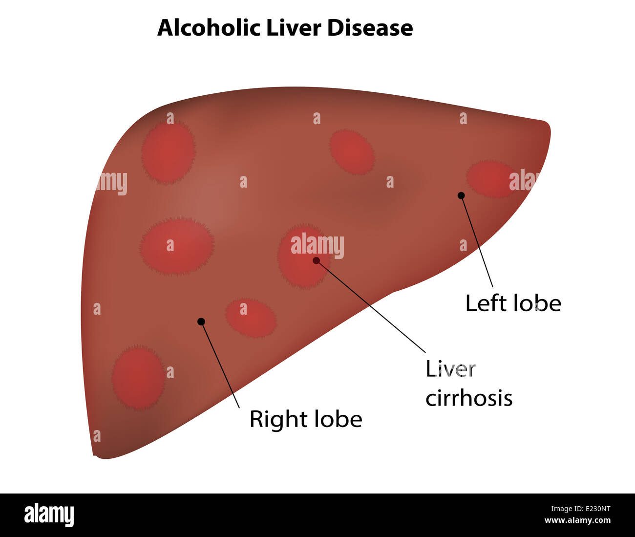 Alcoholic Liver DIsease Stock Photo - Alamy