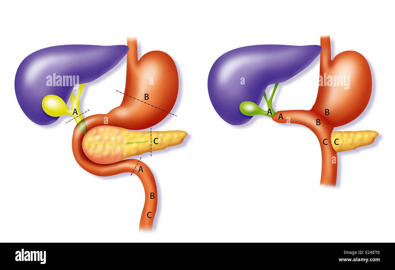 Jejunum tube Cut Out Stock Images & Pictures - Alamy