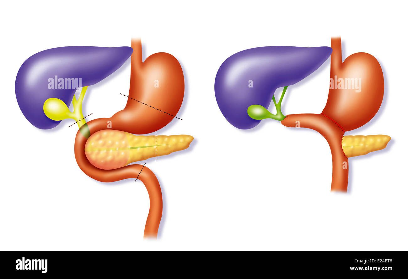 Bowel resection hi-res stock photography and images - Alamy