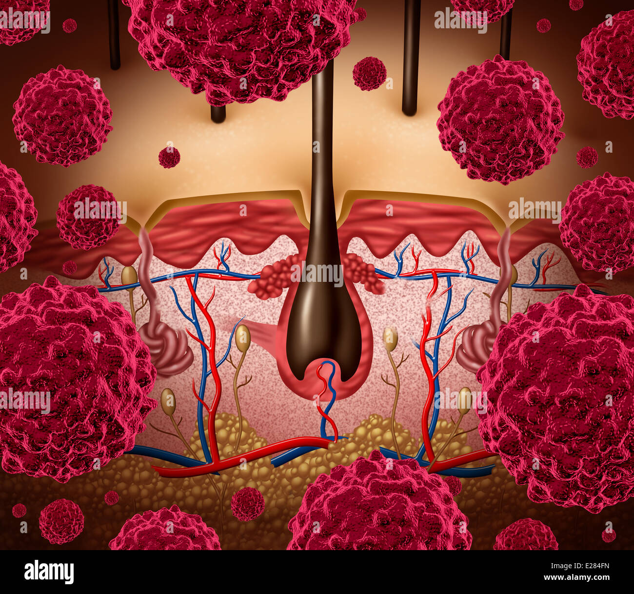 Skin cancer and melanoma medical concept as a human epidermis anatomy ...