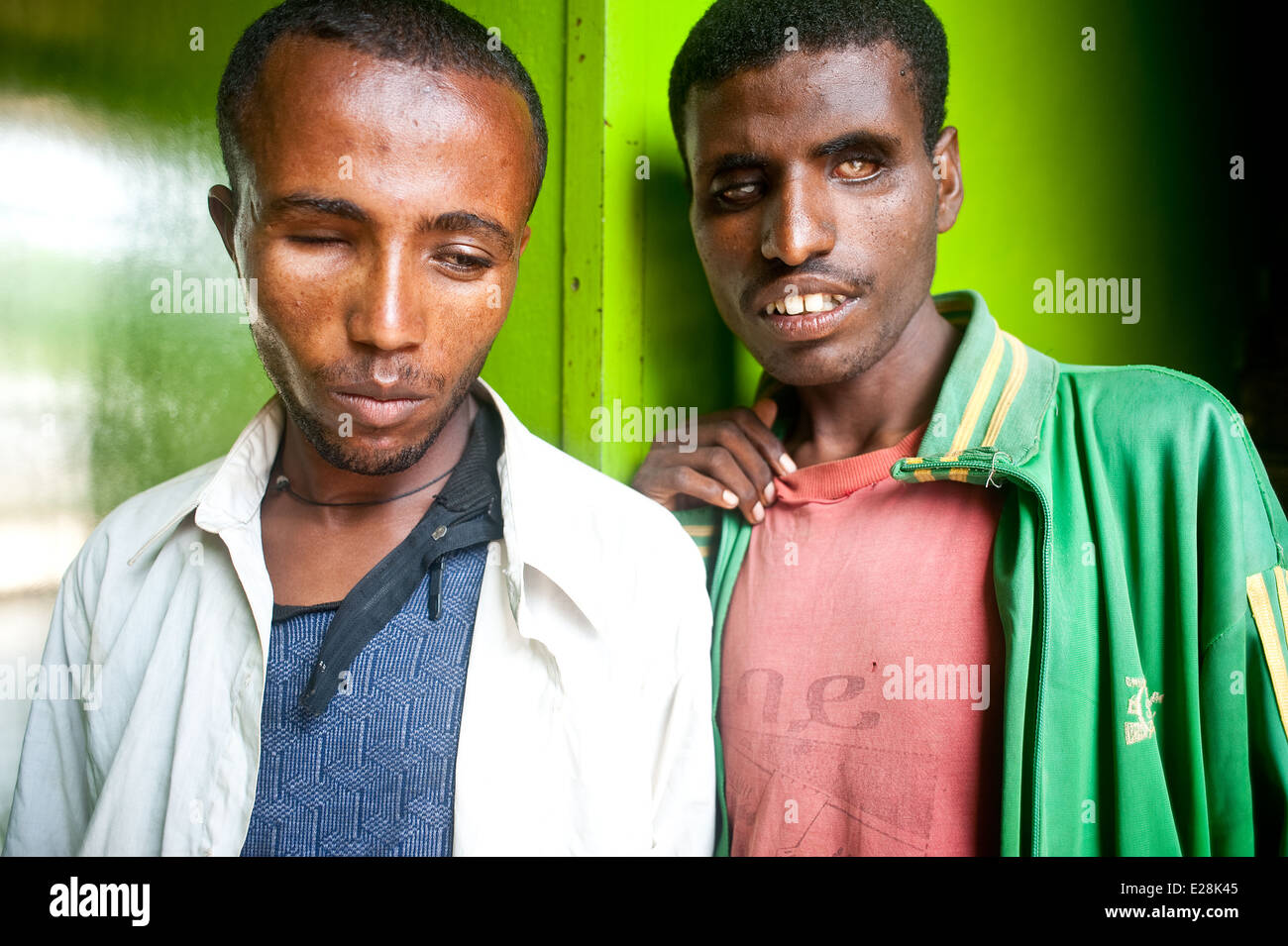One visually impaired and one blind man suffering from trachoma ...