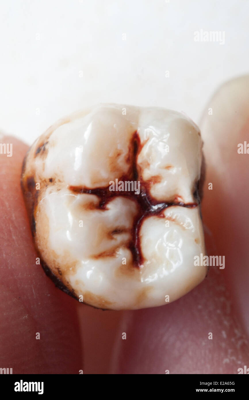 The tooth has stains of blood from the extraction Stock Photo - Alamy