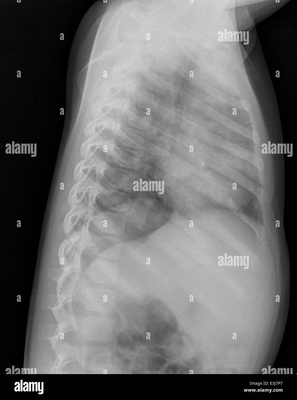 Pneumonia Lateral Chest X Ray