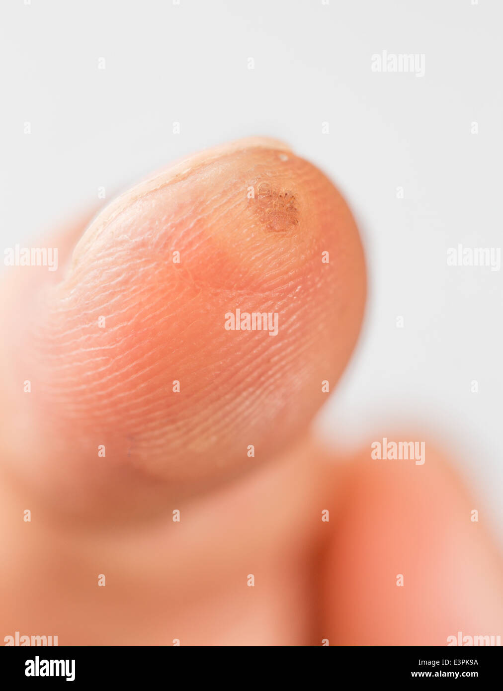 Verruca hi-res stock photography and images - Alamy