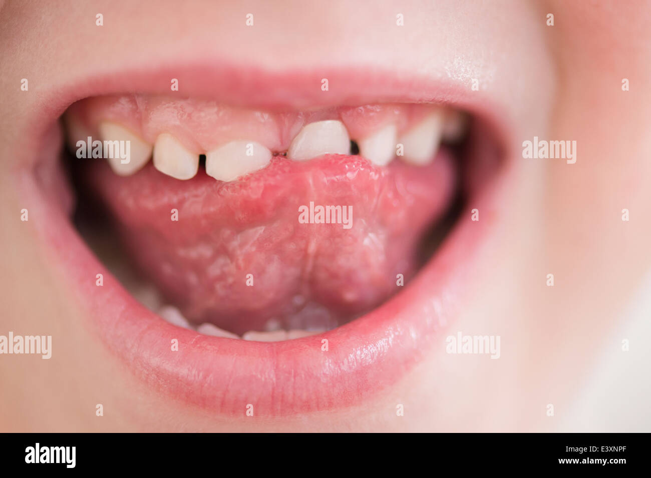 Loose tooth hi-res stock photography and images - Alamy