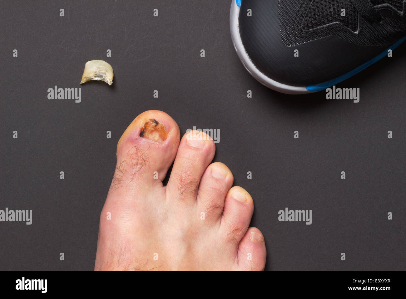 Foot infection hi-res stock photography and images - Alamy