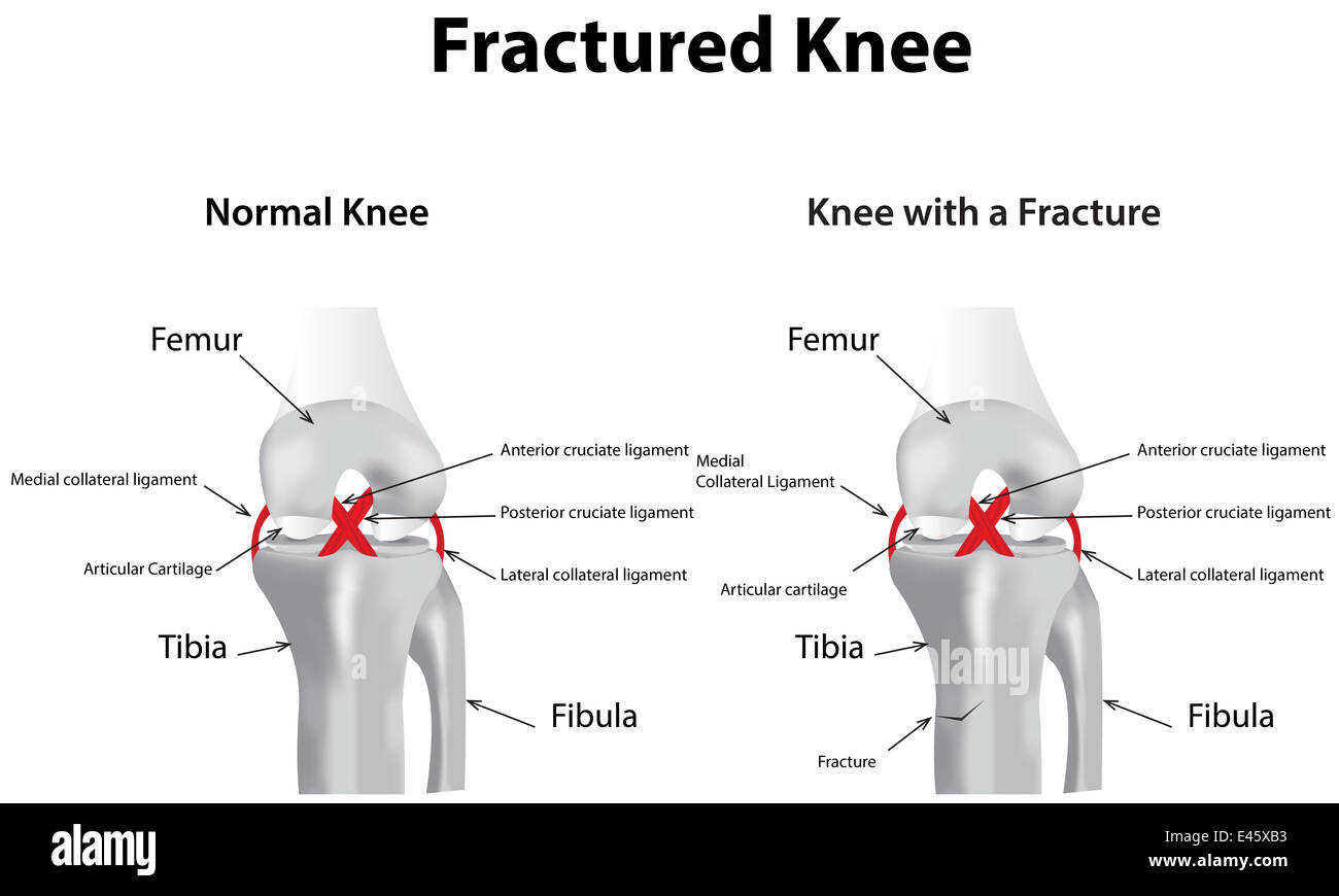 Fractured knee Cut Out Stock Images & Pictures - Alamy