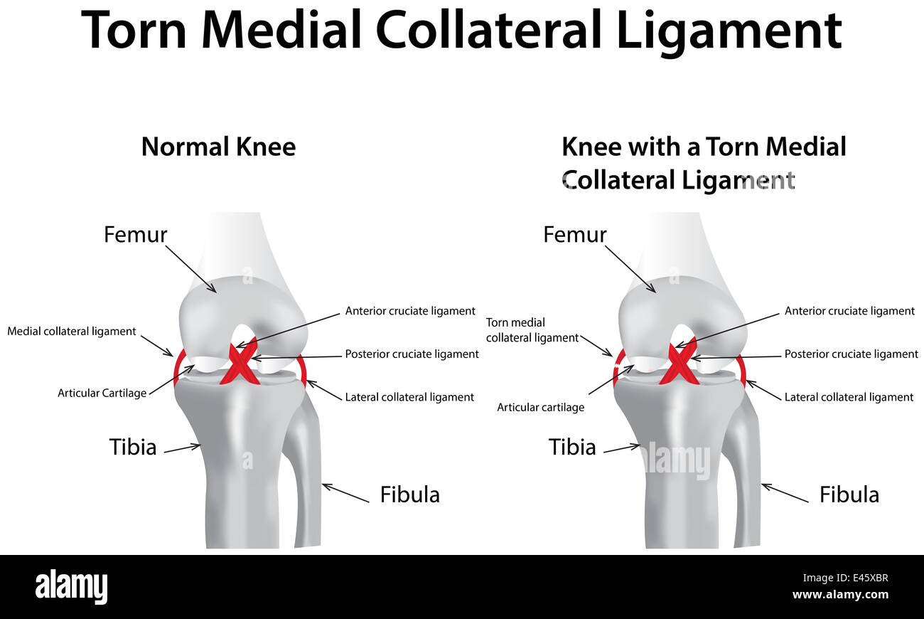 Torn Medial Collateral Ligament Stock Photo - Alamy