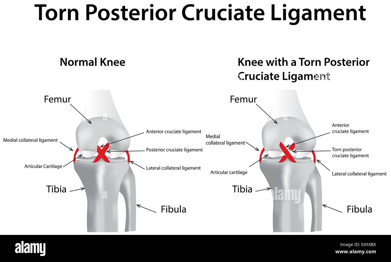 Torn Posterior Cruciate Ligament Stock Photo - Alamy