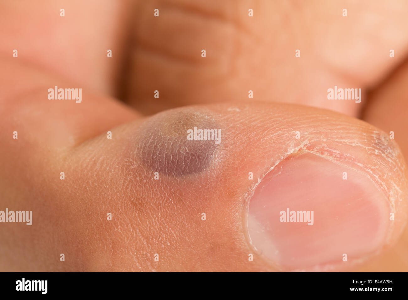 Verruca hi-res stock photography and images - Alamy