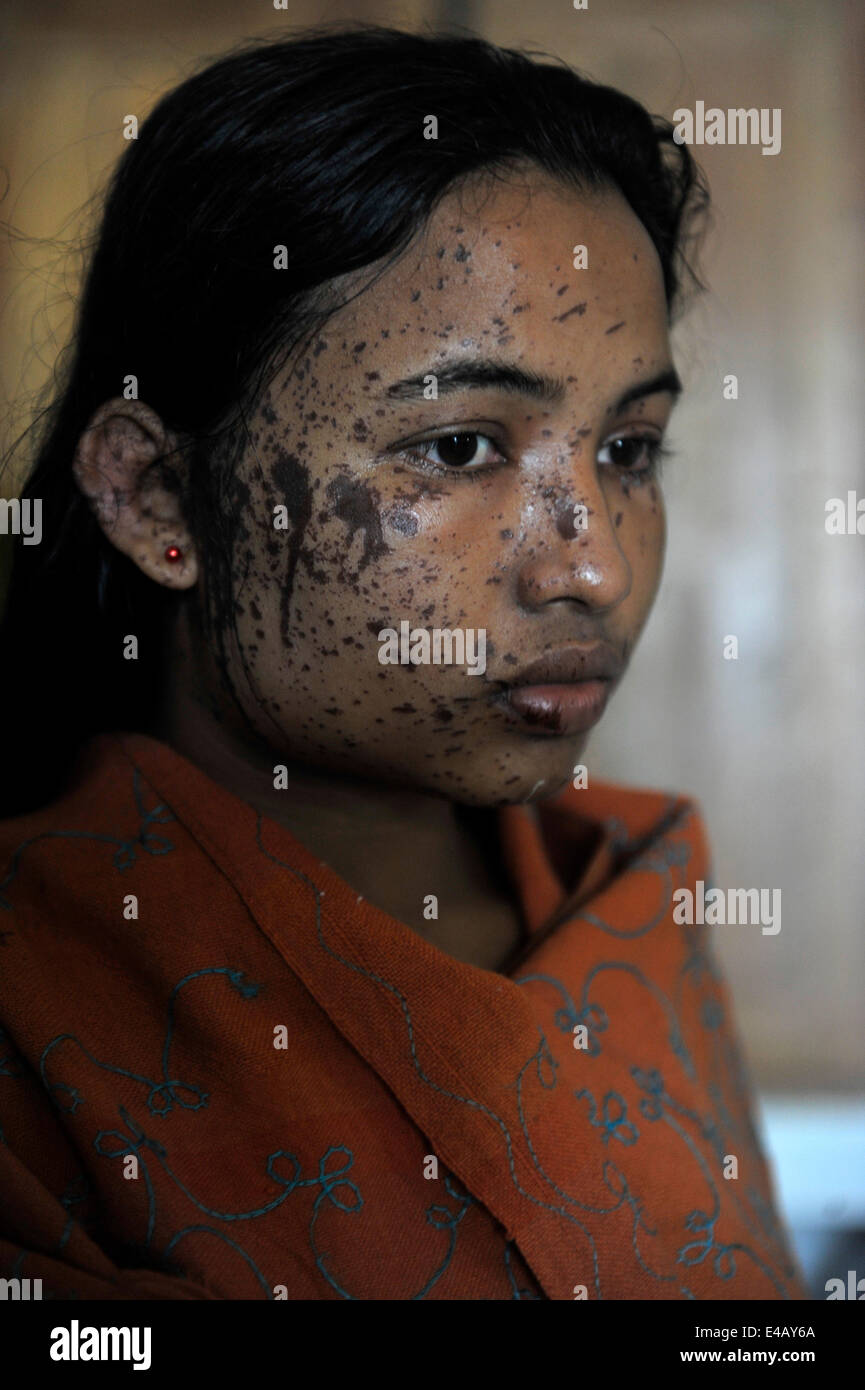 Dhaka, Bangladesh. 7th July, 2014. A young lady with an acid burnt-face ...