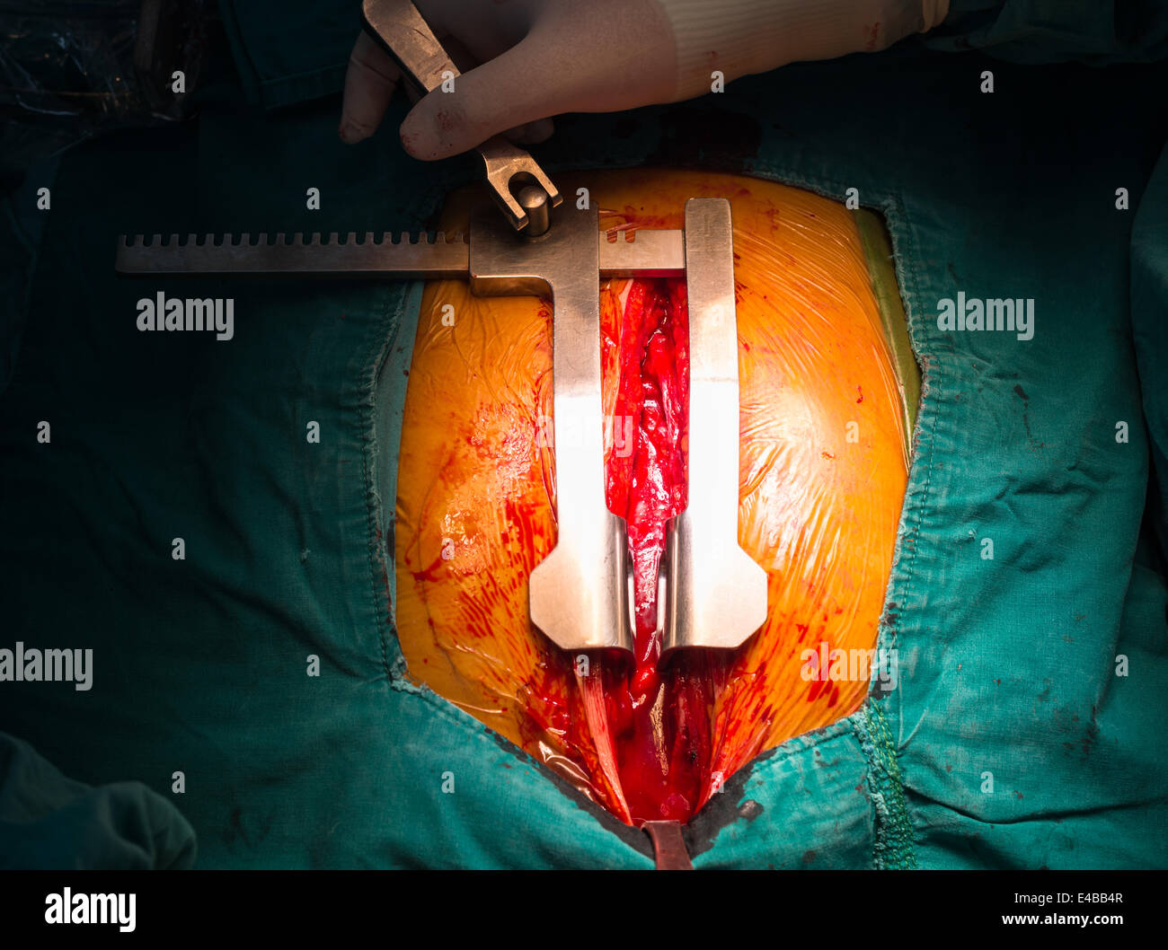Sternum incision hi-res stock photography and images - Alamy