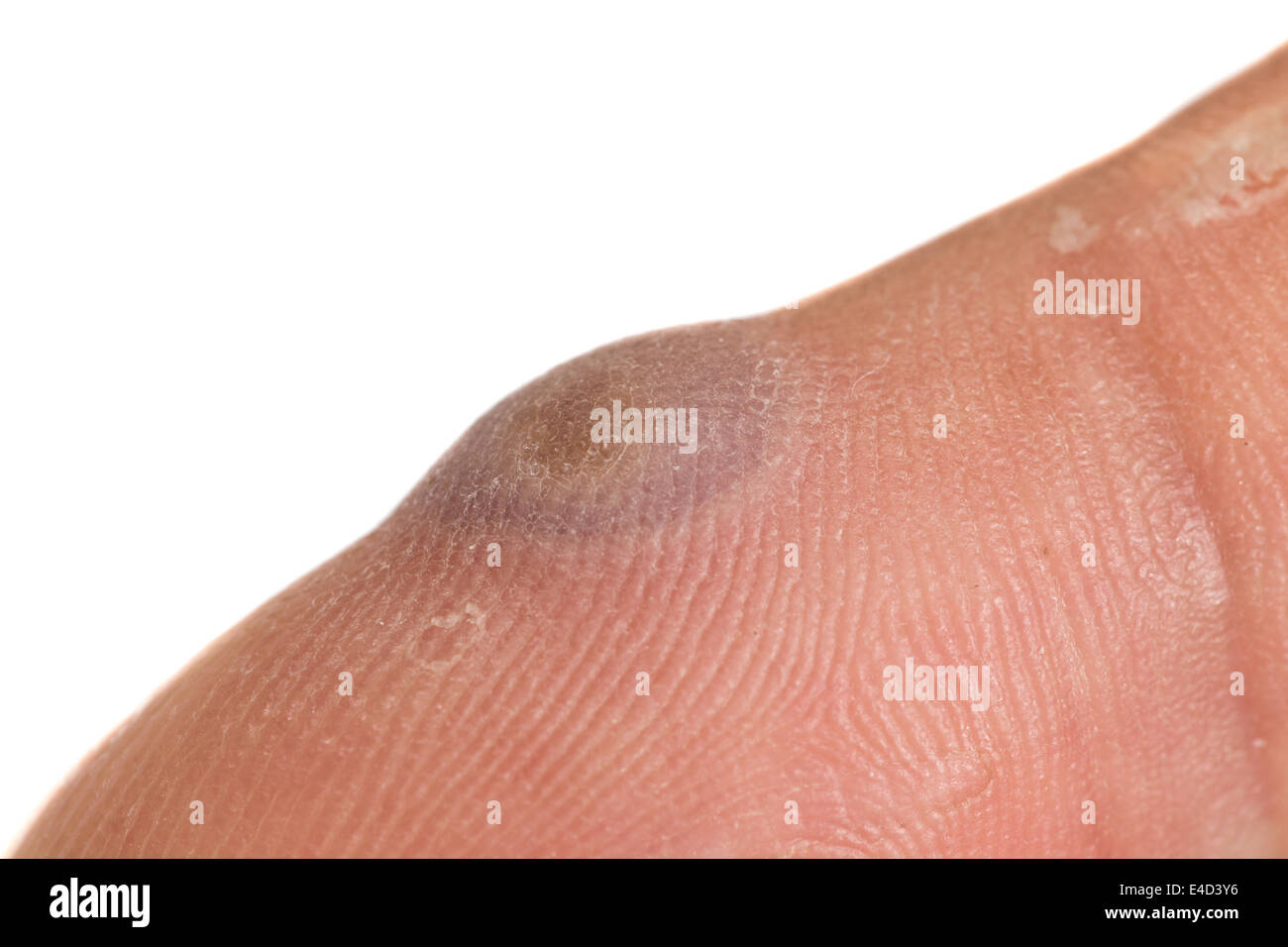 Verruca hi-res stock photography and images - Alamy