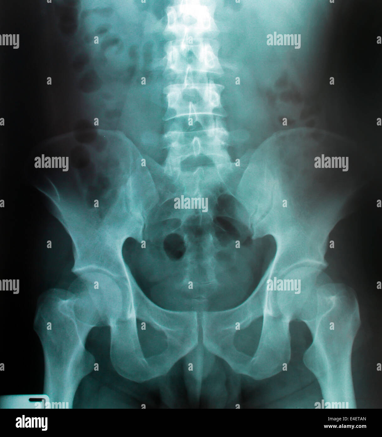 Young Female Pelvis X Ray Normal