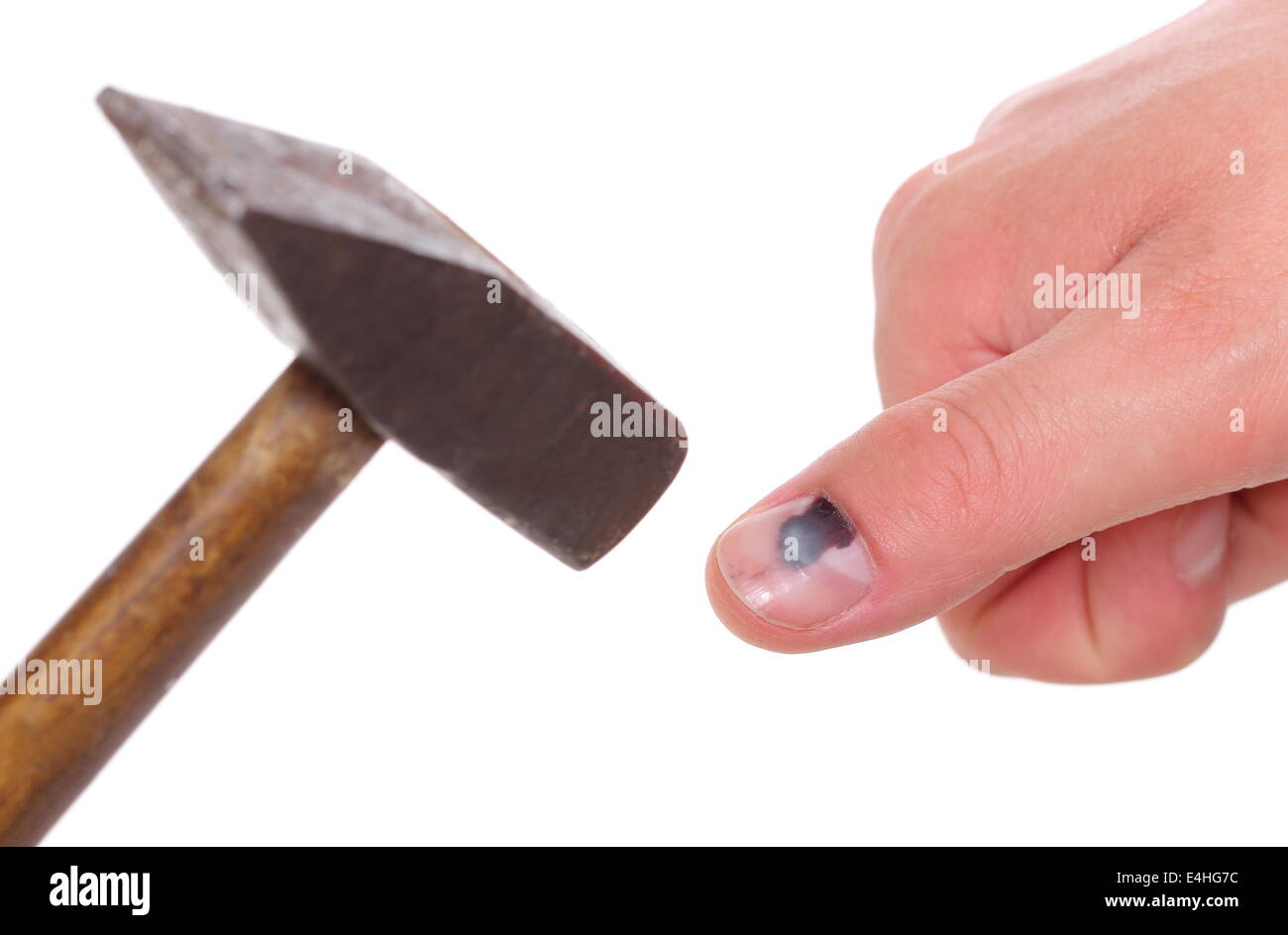 Hammer and human finger with black bruised nail, subungual hematoma ...