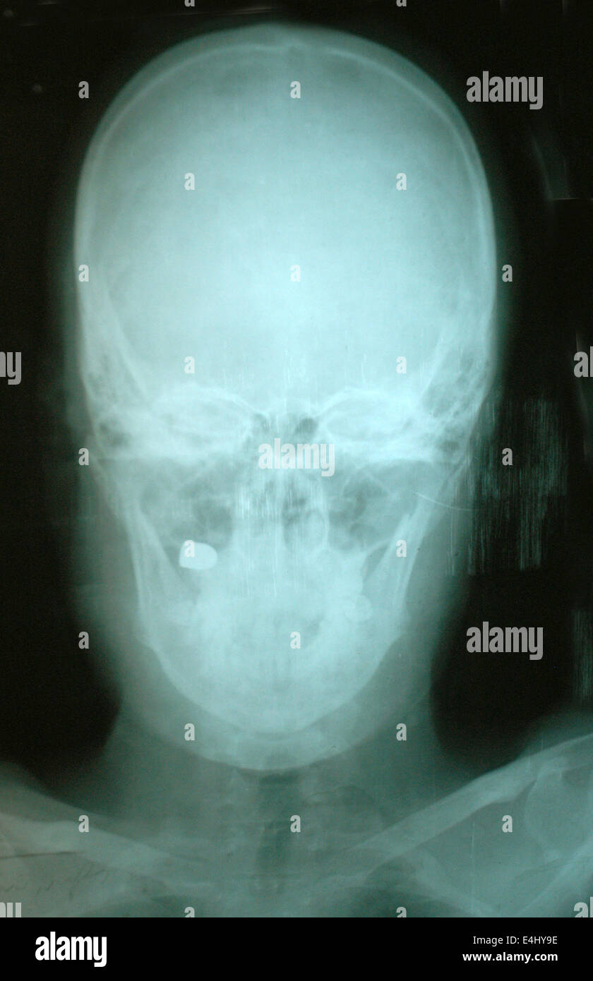 The x-ray shows exactly the location of the bullet on the right side ...
