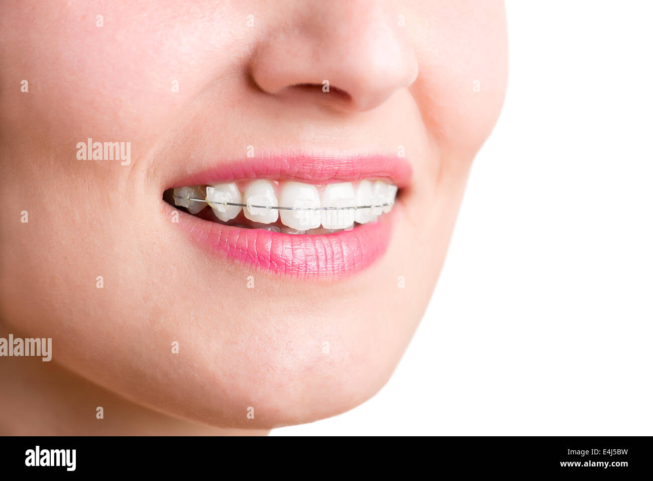 Closeup of a mouth with braces on teeth and the tongue out, isolated in ...