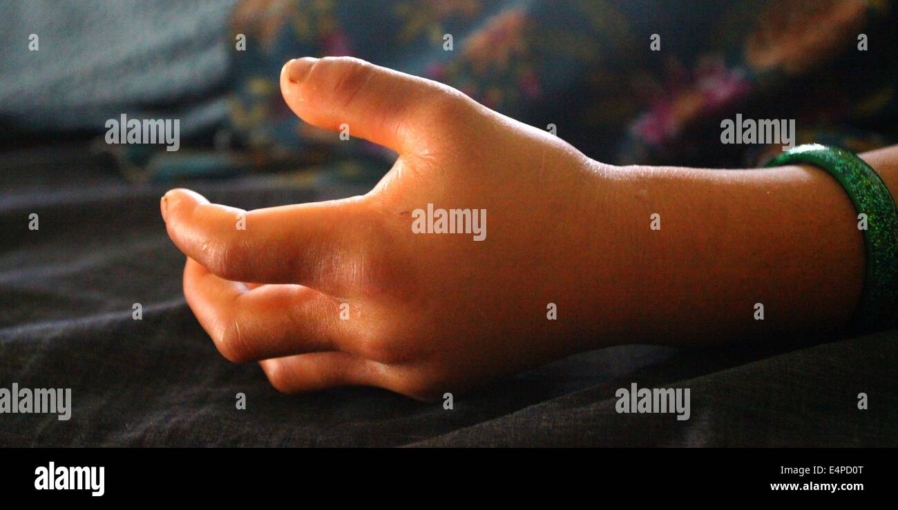 Swollen hand bite High Resolution Stock Photography and Images - Alamy