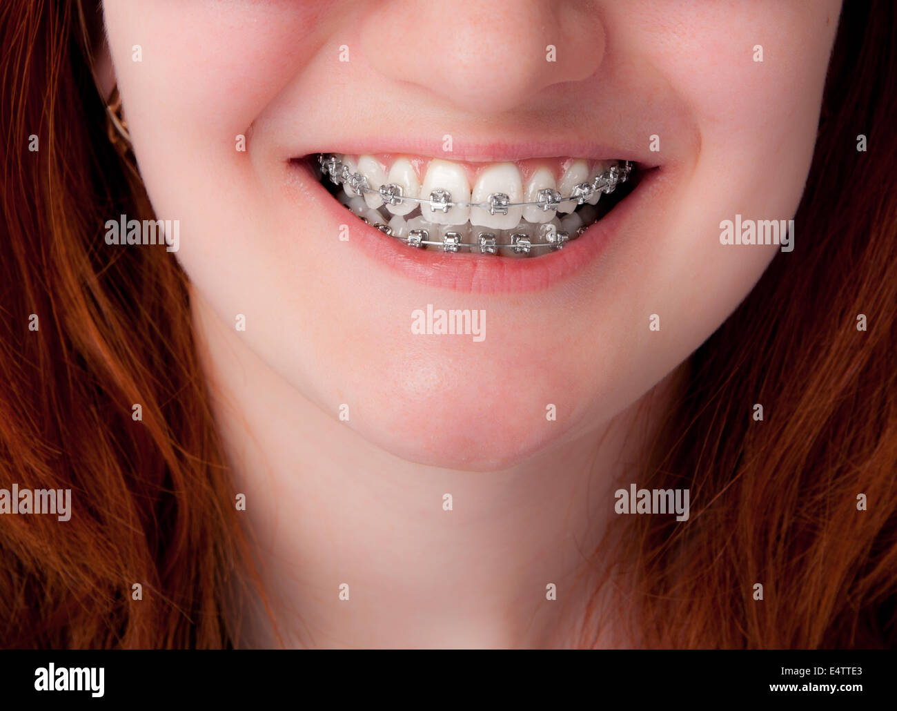 Teeth braces hi-res stock photography and images - Alamy