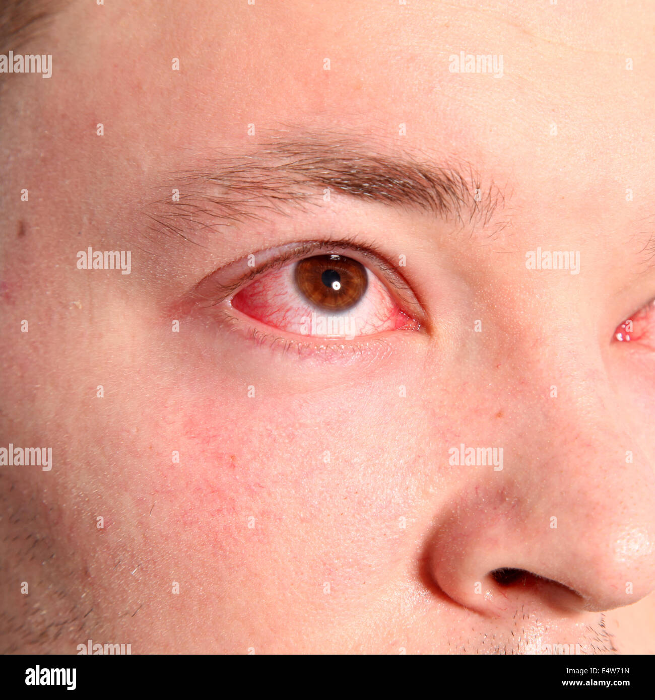 Man with conjunctivitis Stock Photo - Alamy