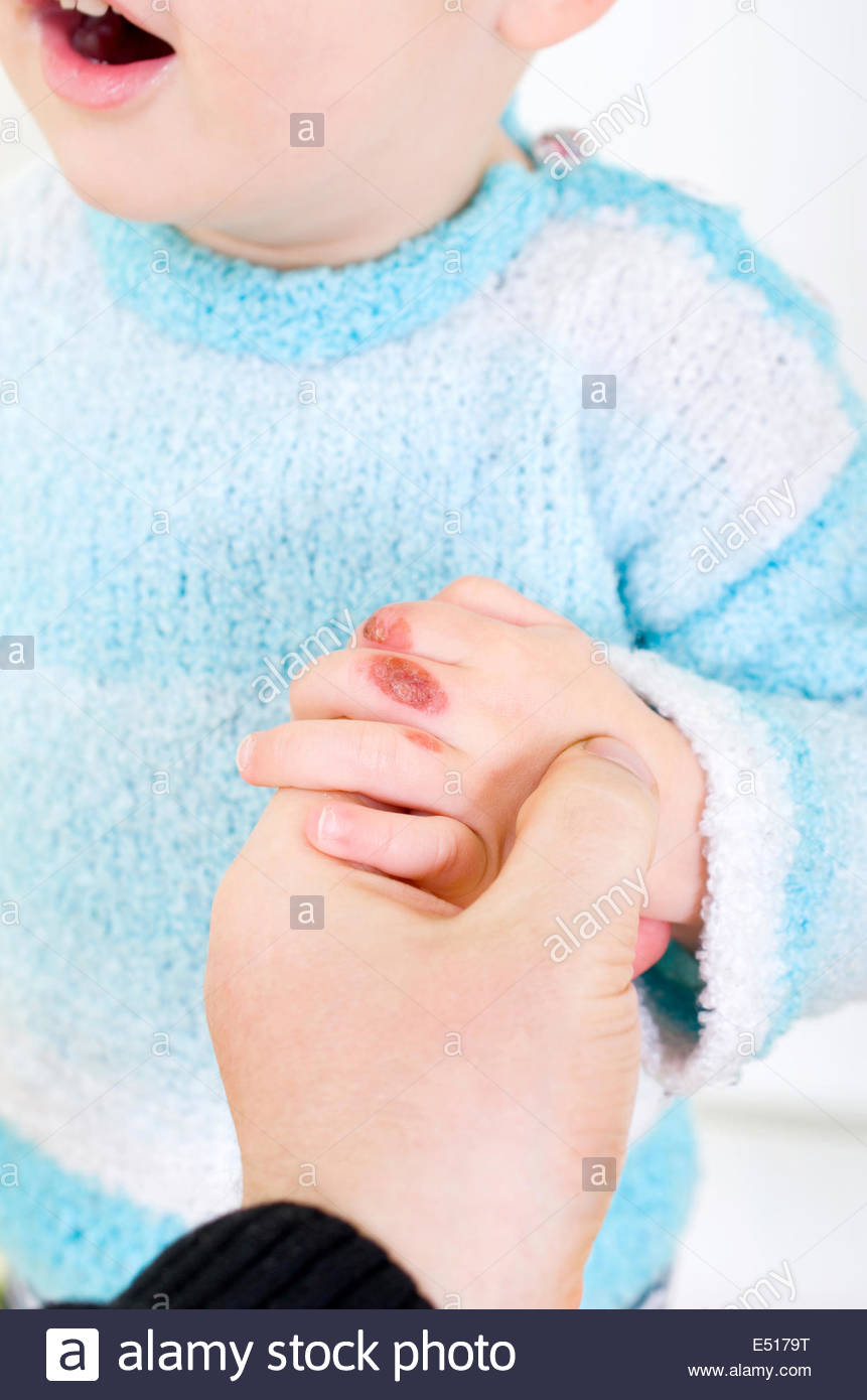 Child Abuse Injuries Stock Photos & Child Abuse Injuries Stock Images ...