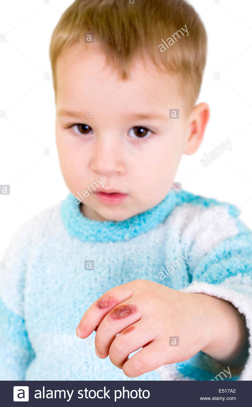 Injury Burn Hand Stock Photos & Injury Burn Hand Stock Images - Alamy