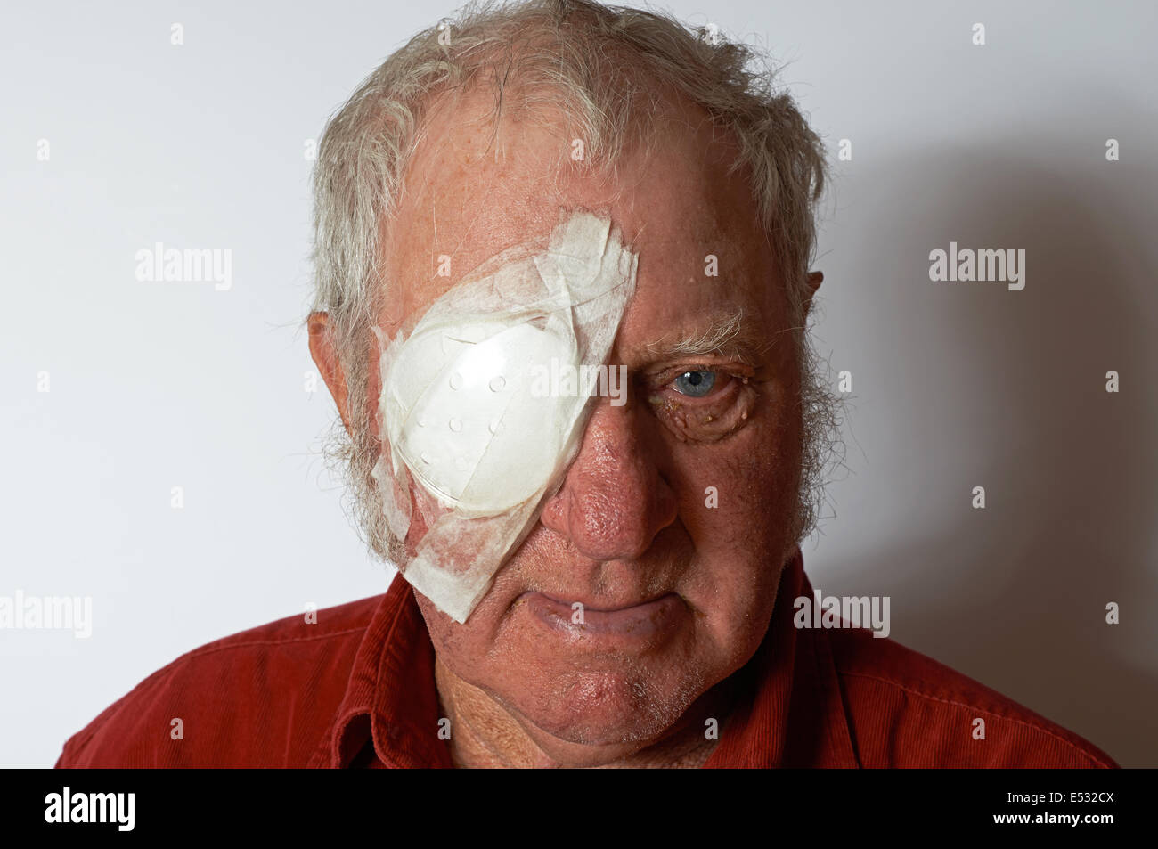 Cataract hi-res stock photography and images - Alamy