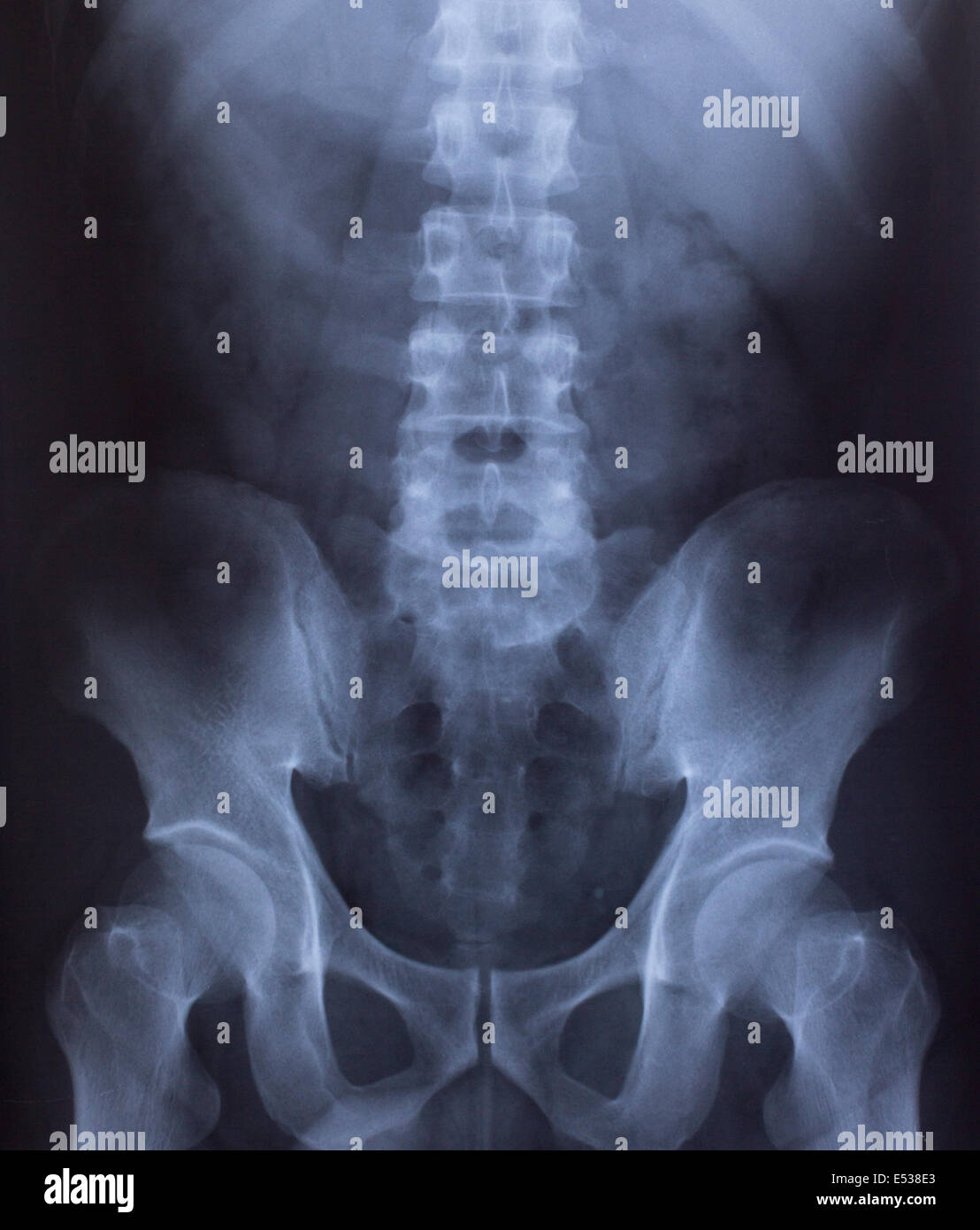 X-ray of the pelvis and spinal column Stock Photo - Alamy