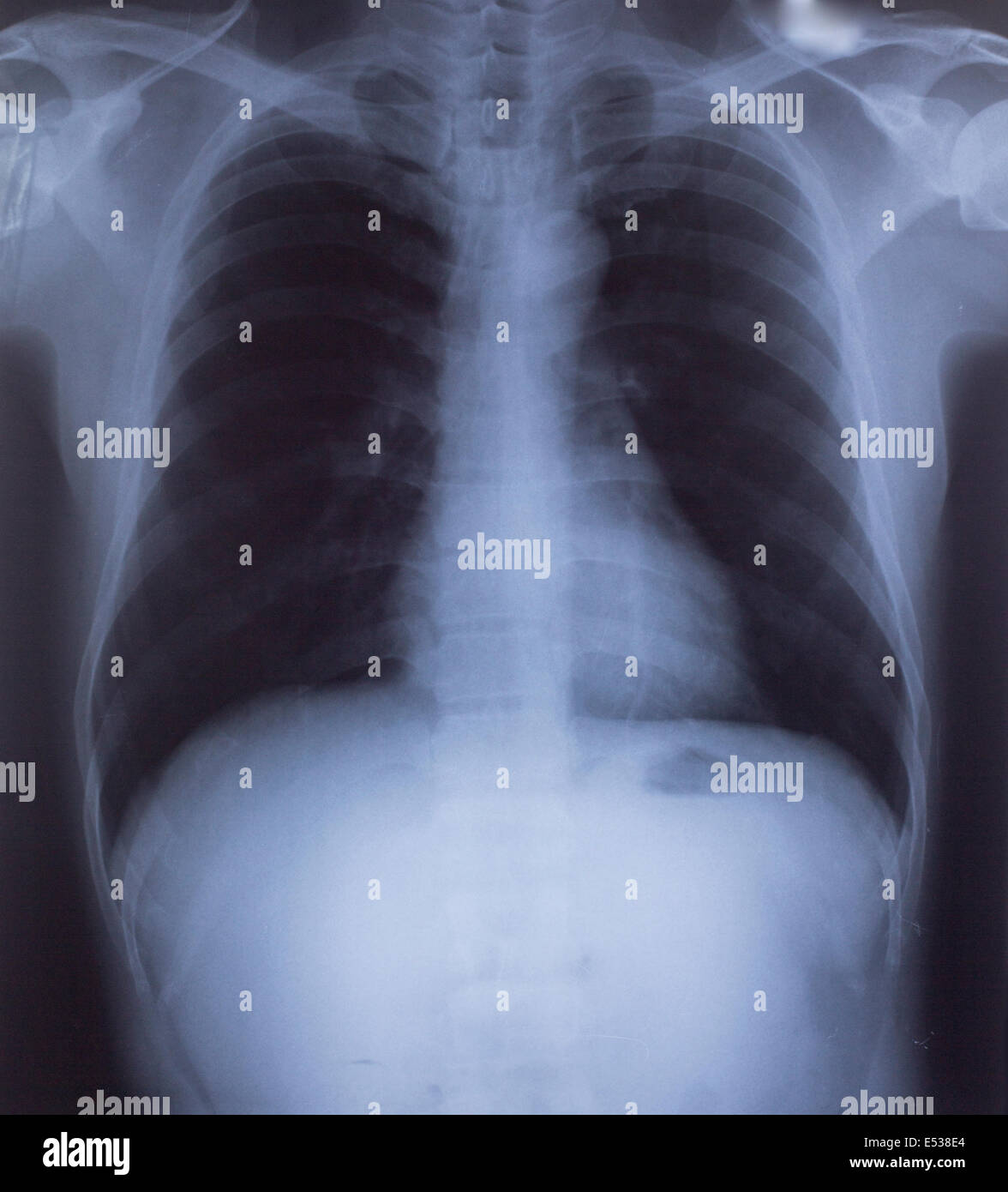 X-Ray Image Of Human Chest for a medical diagnosis Stock Photo - Alamy