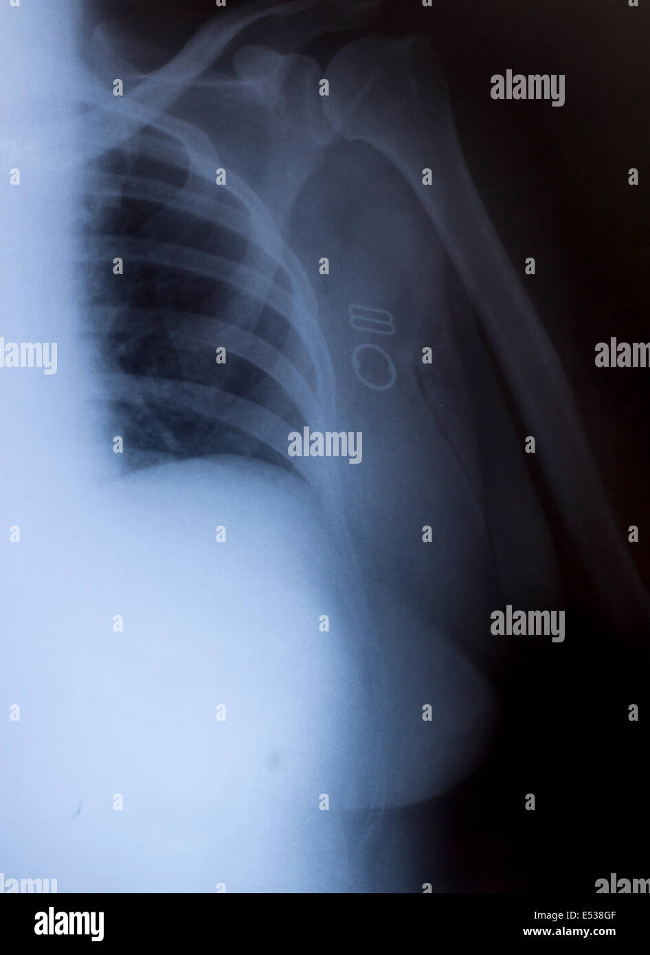 X-Ray Image Of Human Chest for a medical diagnosis Stock Photo - Alamy